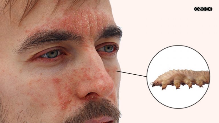Demodex Brevis: Your Glamorous Skin Potential Enemy - OZIDEX