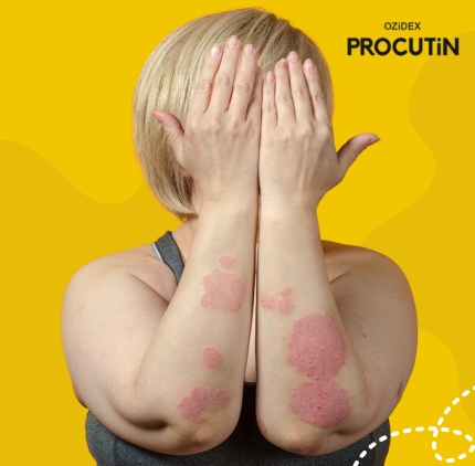 Humans Demodicosis: Signs, Causes, Treatments | OZiDEX