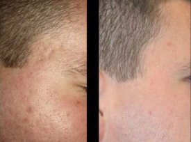 Acne Solution | Demodex Mite Skin Treatment | Procutin | Ozidex