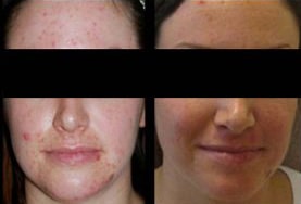 Acne Solution | Demodex Mite Skin Treatment | Procutin | Ozidex