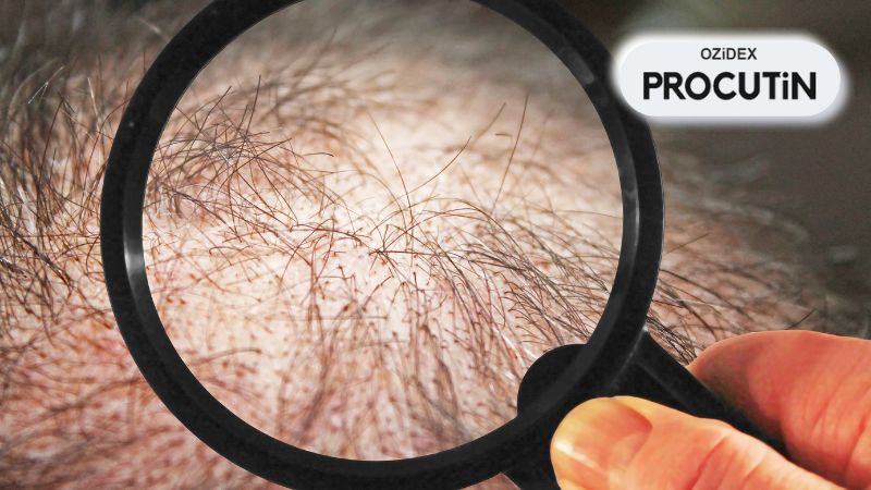 Demodex Mites Cause Hair Loss - Infoupdate.org