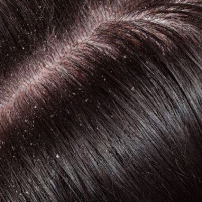 Seborrheic Dermatitis and Dandruff | Demodex | Ozidex